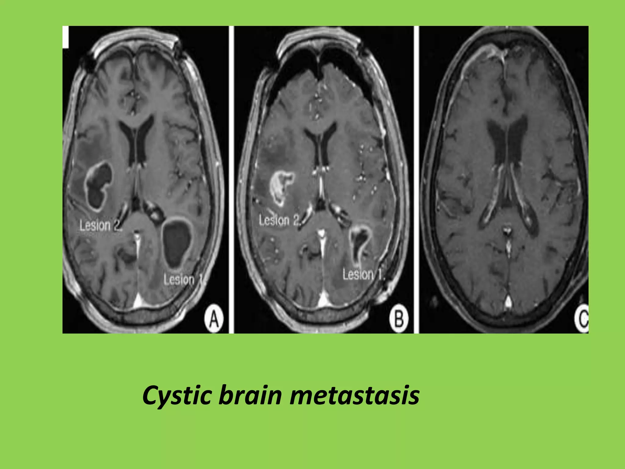 Presentation2.pptx intra cranial cyst | PPTX