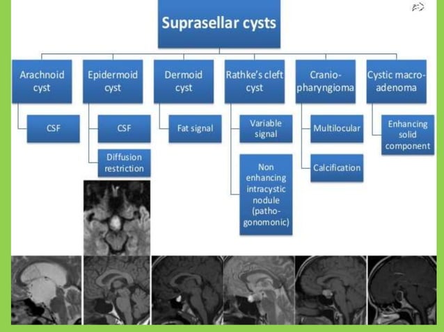 Presentation2.pptx intra cranial cyst | PPTX