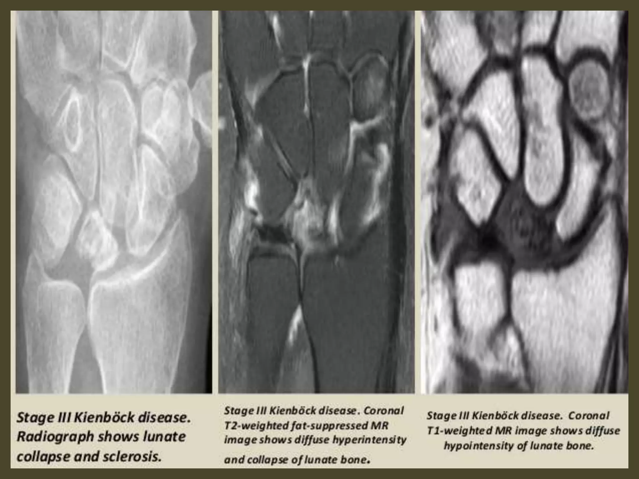 Presentation2.pptx wrist joint. | PPTX | Death, Injury, or Military ...
