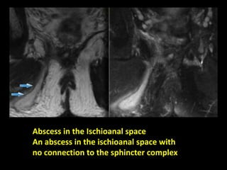 Ischiorectal Abscess Mri