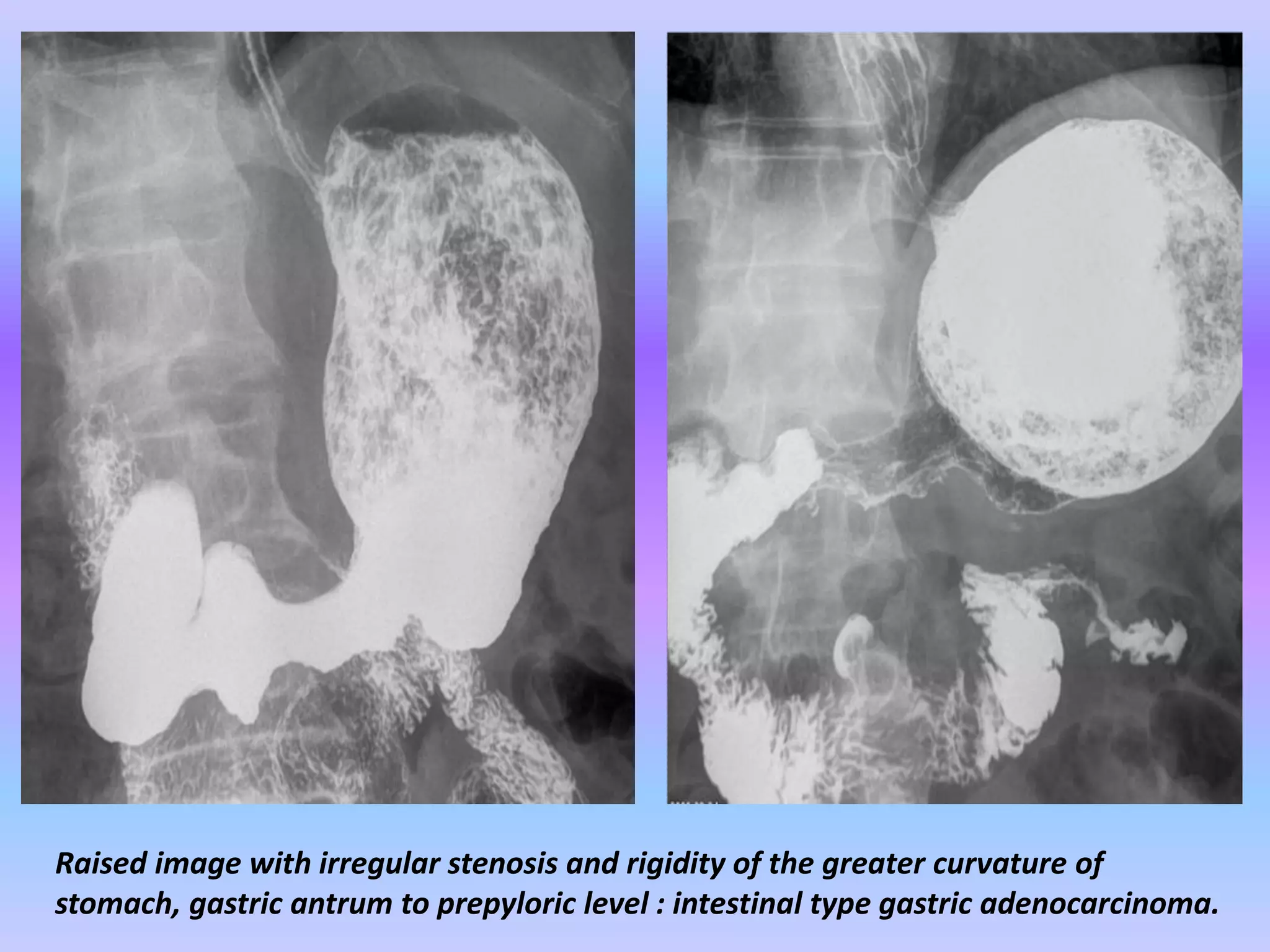 Presentation2.pptx, radiological imaging of gastric lesions. | PPTX