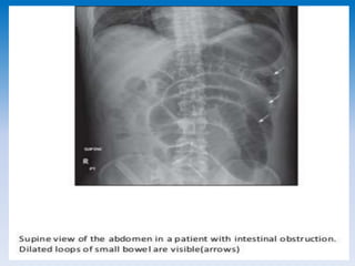 Presentation2.pptx. radilogical imaging of intestinal obstruction. | PPTX