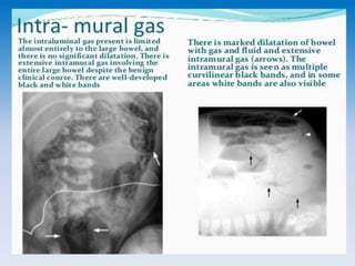 Small Bowel Obstruction X Ray