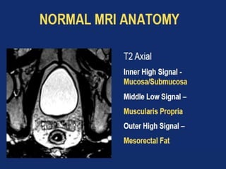 Rectum Anatomy Mri