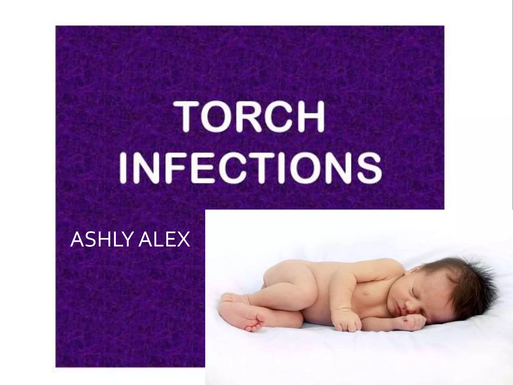 TORCH INFECTIONS | PPTX