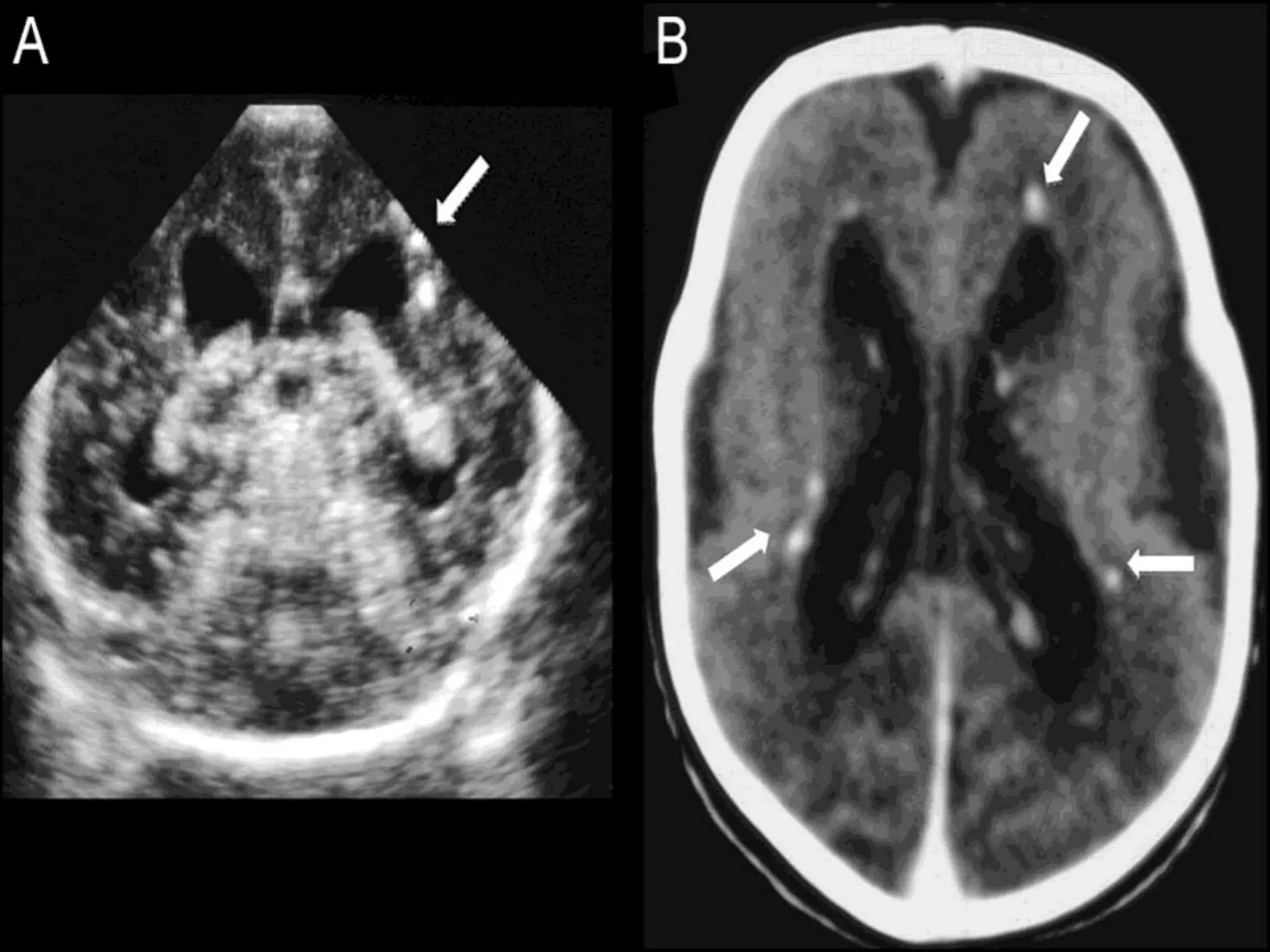 TORCH INFECTIONS | PPTX