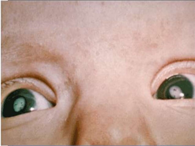 TORCH INFECTIONS | PPTX