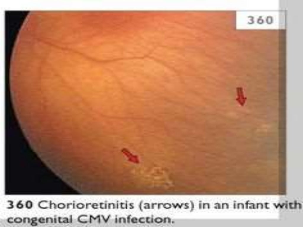 TORCH INFECTIONS TORCH INFECTIONS