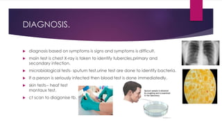 tuberculosis ppt by laxmi prasanna vemireddy | PPT