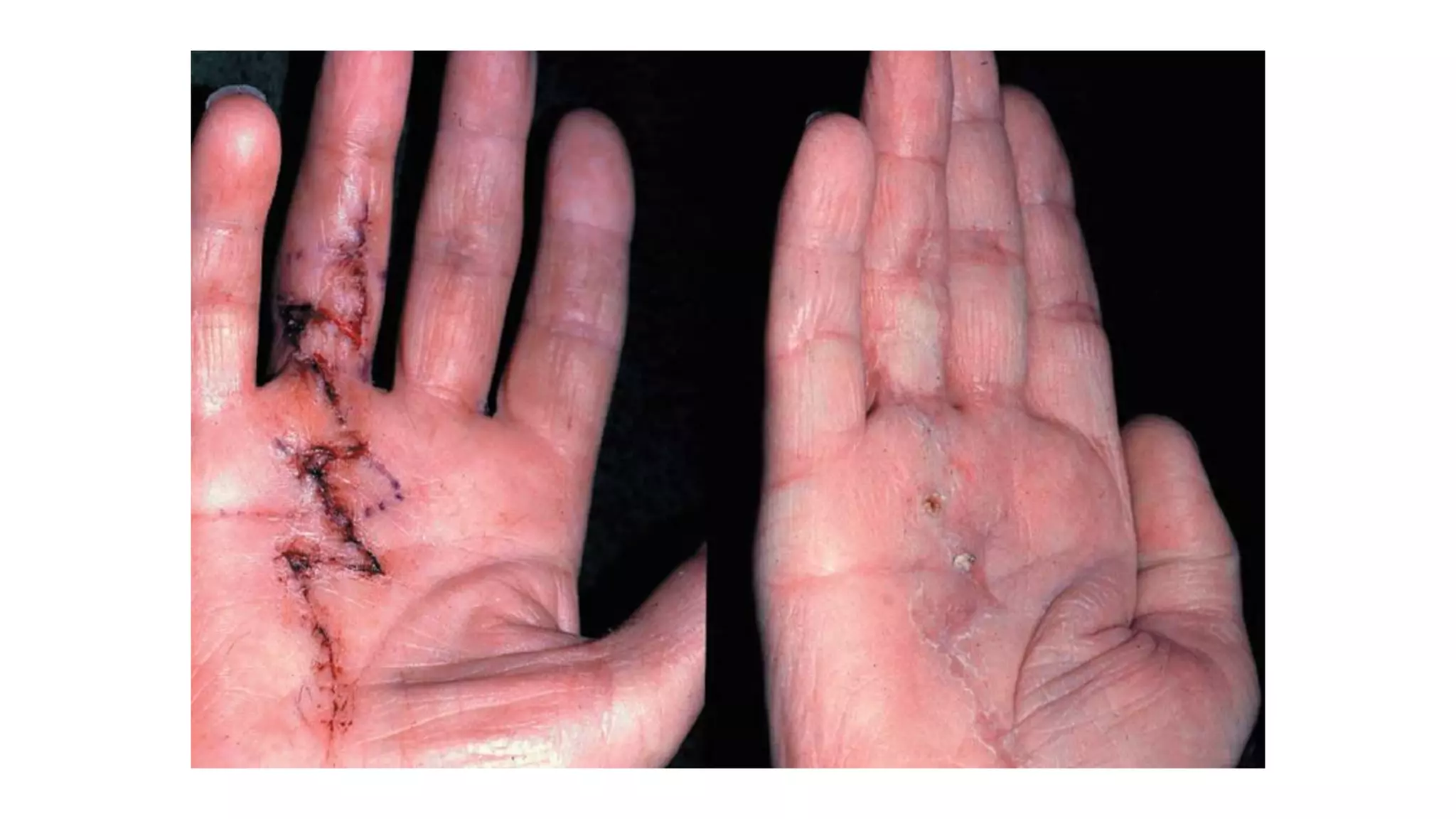 Photo Session: Dupuytren's Contracture | PPTX