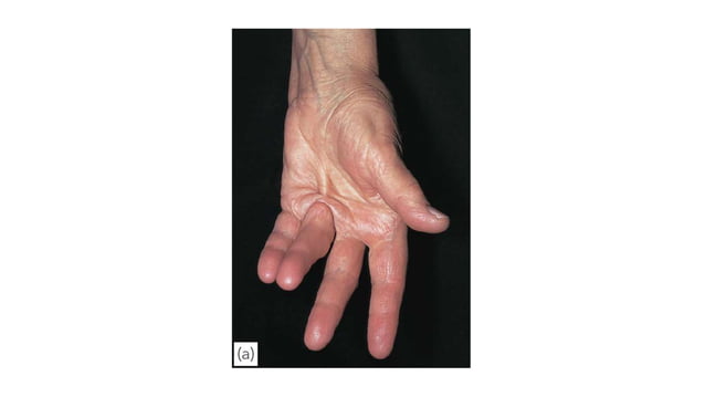 Photo Session: Dupuytren's Contracture | PPTX