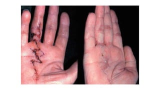 Photo Session: Dupuytren's Contracture | PPTX