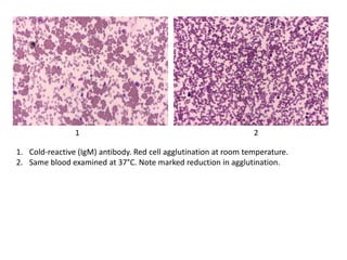 Hemolytic anemia Цус задралын цус багадалт Олдмол | PPTX