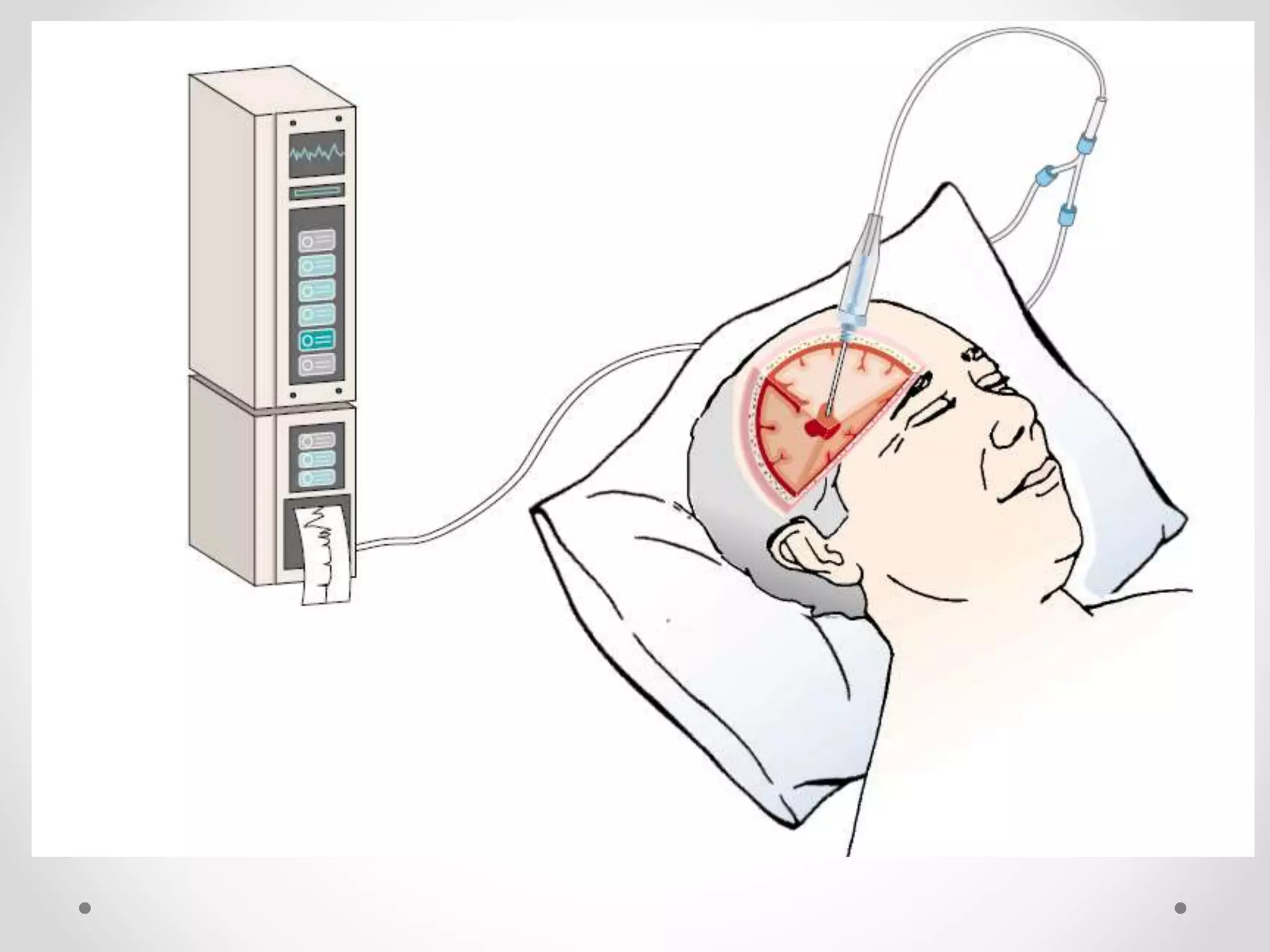 Management of patient with increased intracranial pressure | PPT