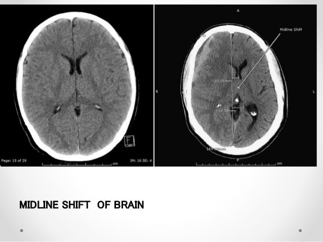 Management of patient with increased intracranial pressure