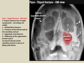 Tripod Fracture X Ray