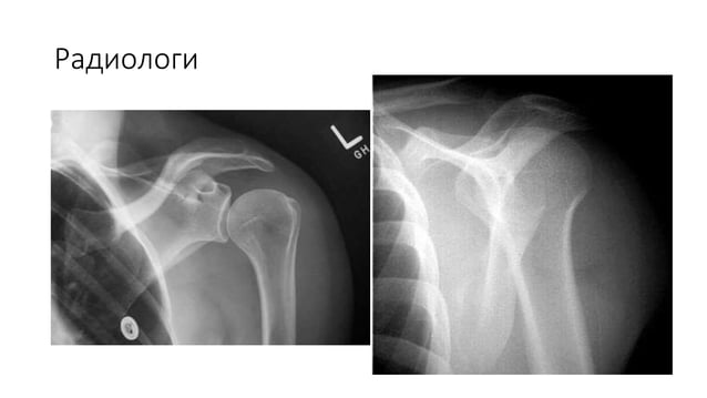 Dislocation of shoulder мөрний мултрал | PPTX