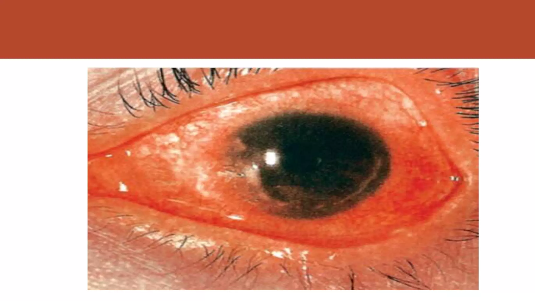 Marginal catarrhal ulcer | PPT