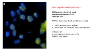 Mucoepidermoid carcinoma (Doctor Faris Alabeedi MSc, MMedSc, PgDip, BDS ...