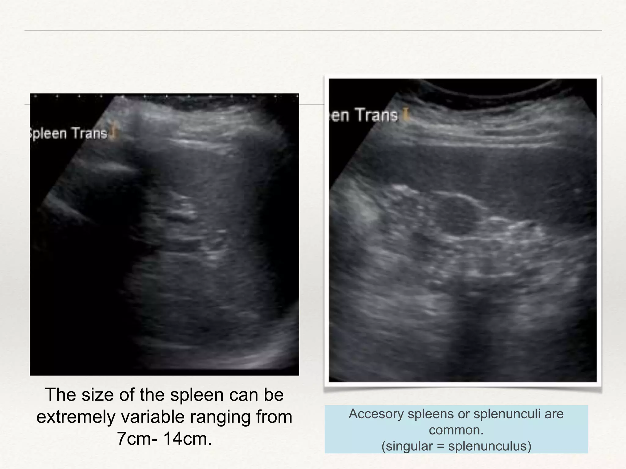 Ultrasound of pancreas and spleen | PPTX | Digestive Disorders ...