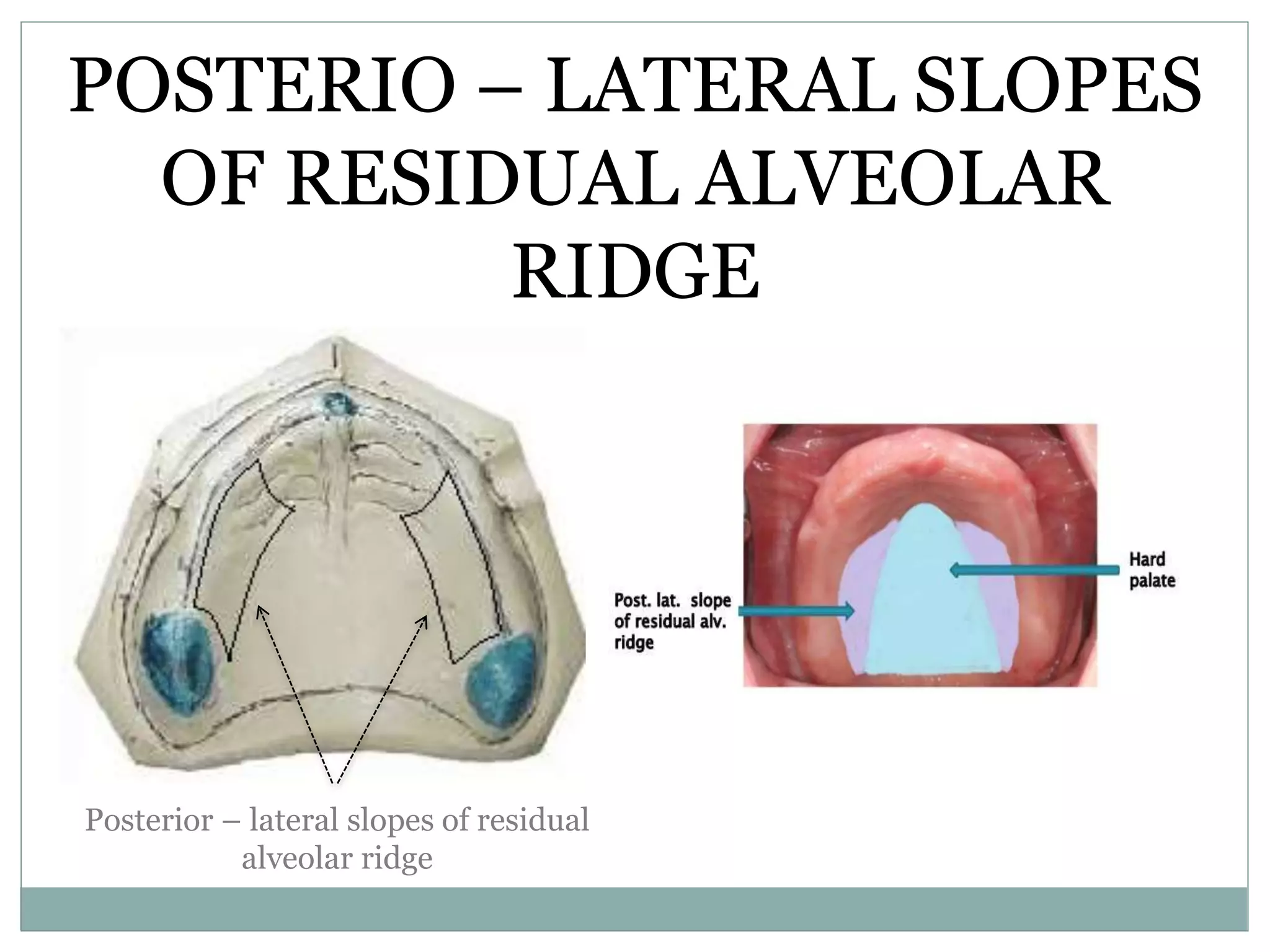 ANATOMICAL LANDMARKS OF MAXILLA | PPTX