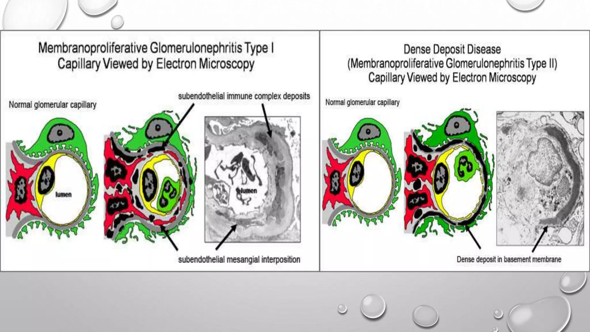 nephrotic and nephritic syndrome | PPTX