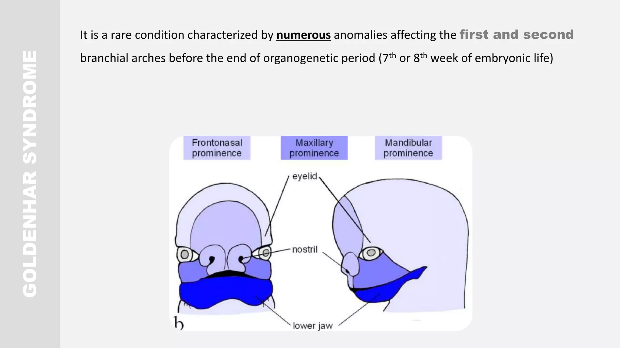 Goldenhar syndrome | PPTX
