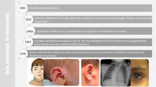 Goldenhar syndrome | PPTX