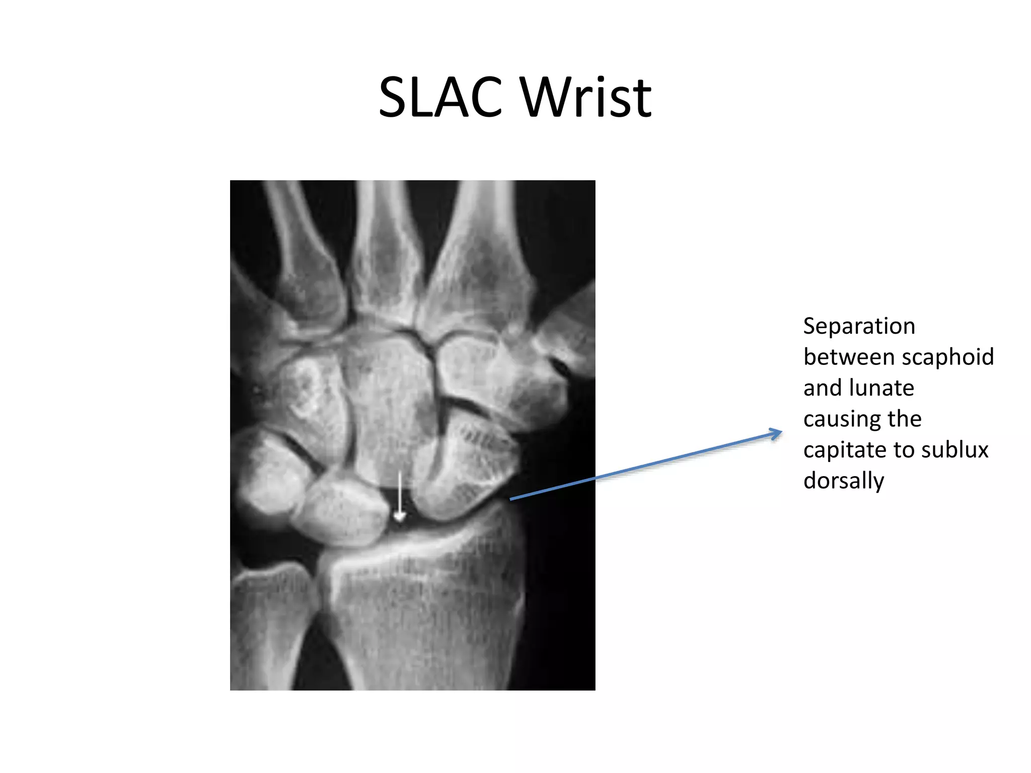 Wrist Joint | PPTX