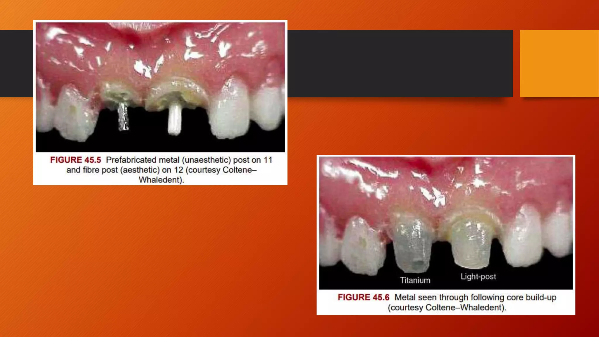restoration of endodontically treated teeth in prosthodontics/ post and ...
