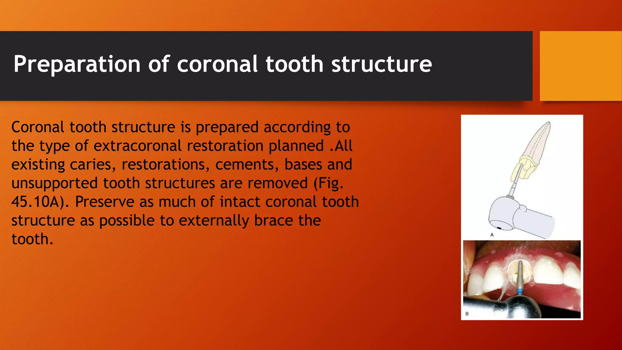 restoration of endodontically treated teeth in prosthodontics/ post and ...