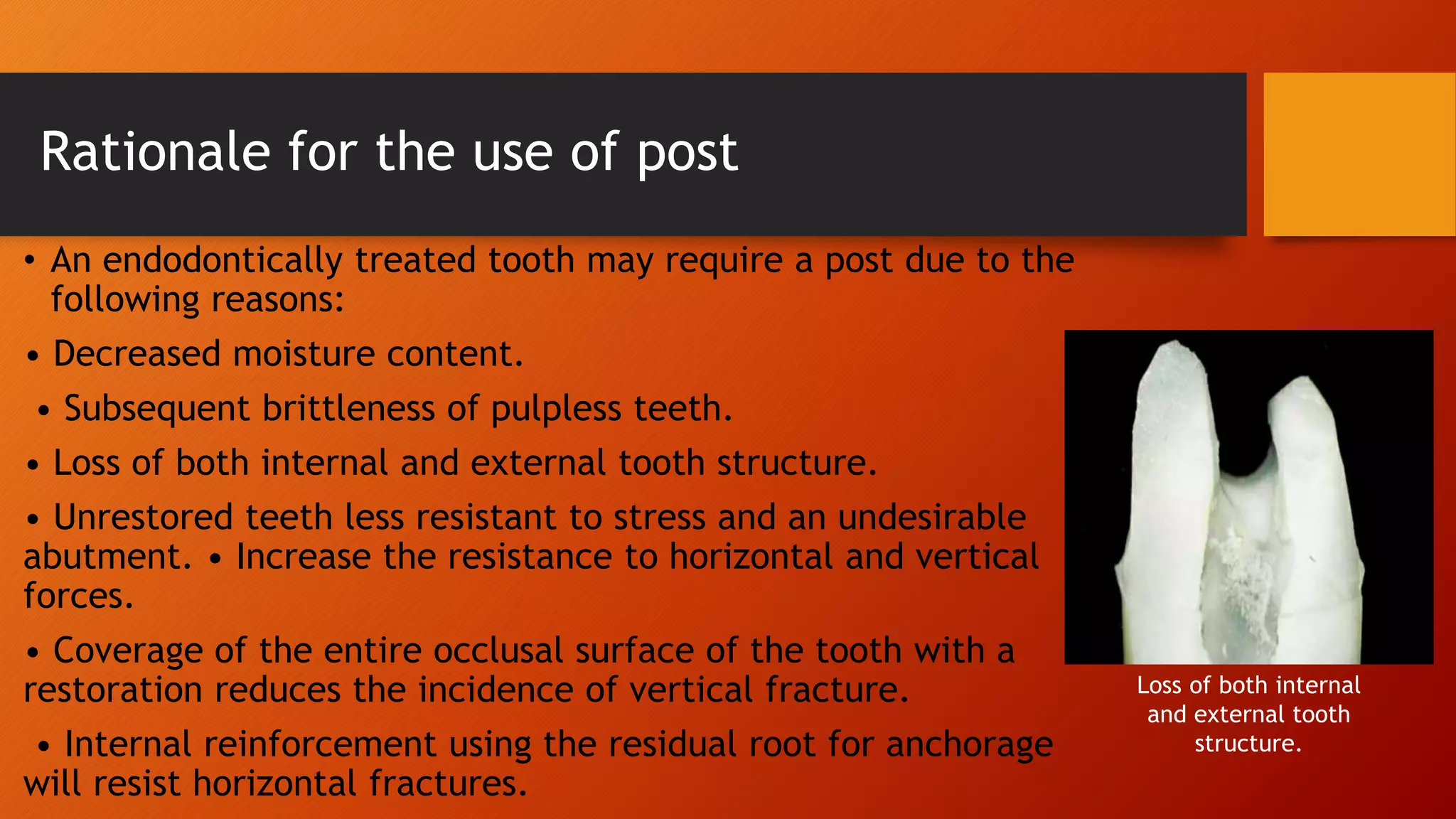 restoration of endodontically treated teeth in prosthodontics/ post and ...