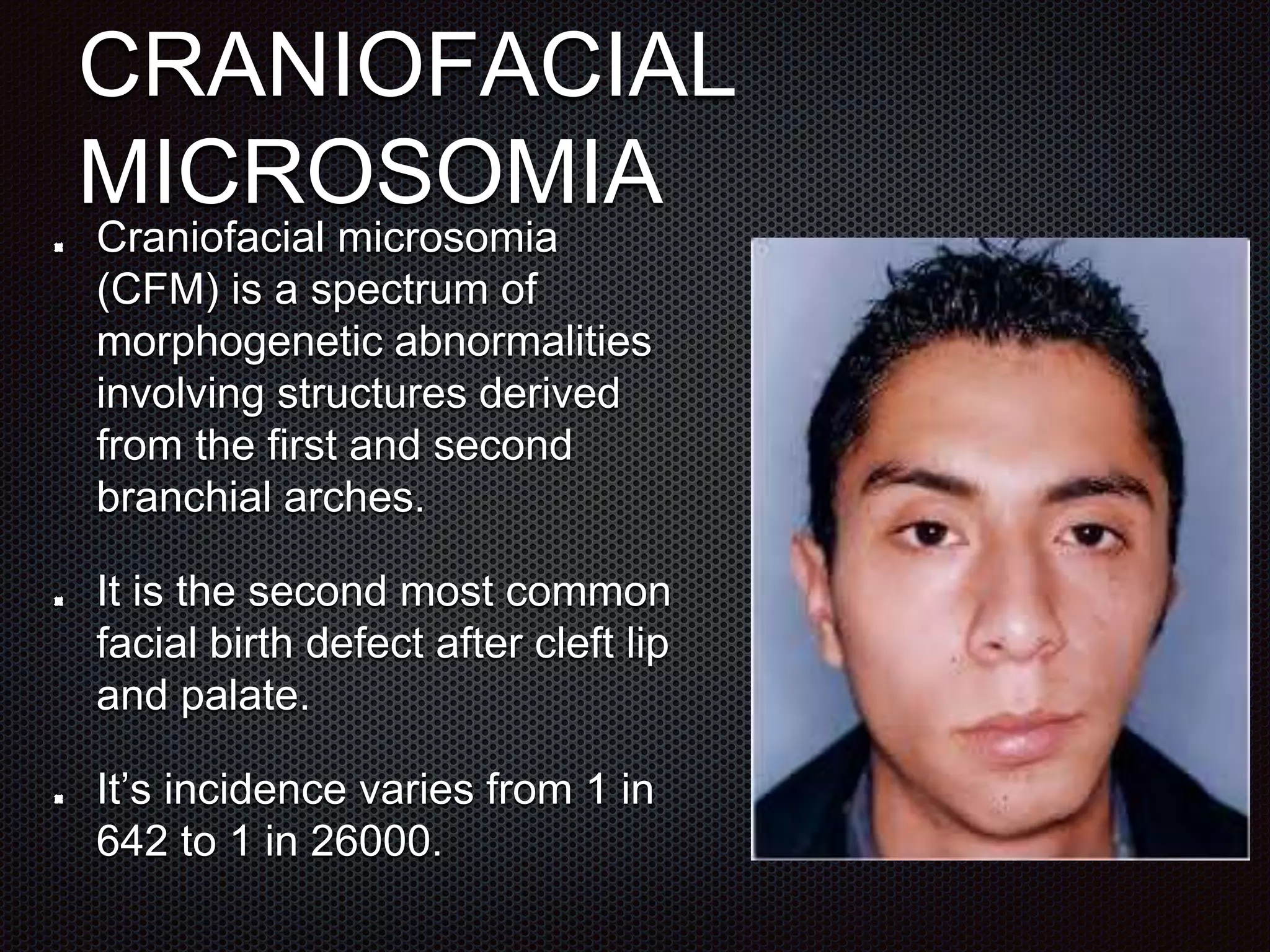 craniofacial microsomia | PPTX