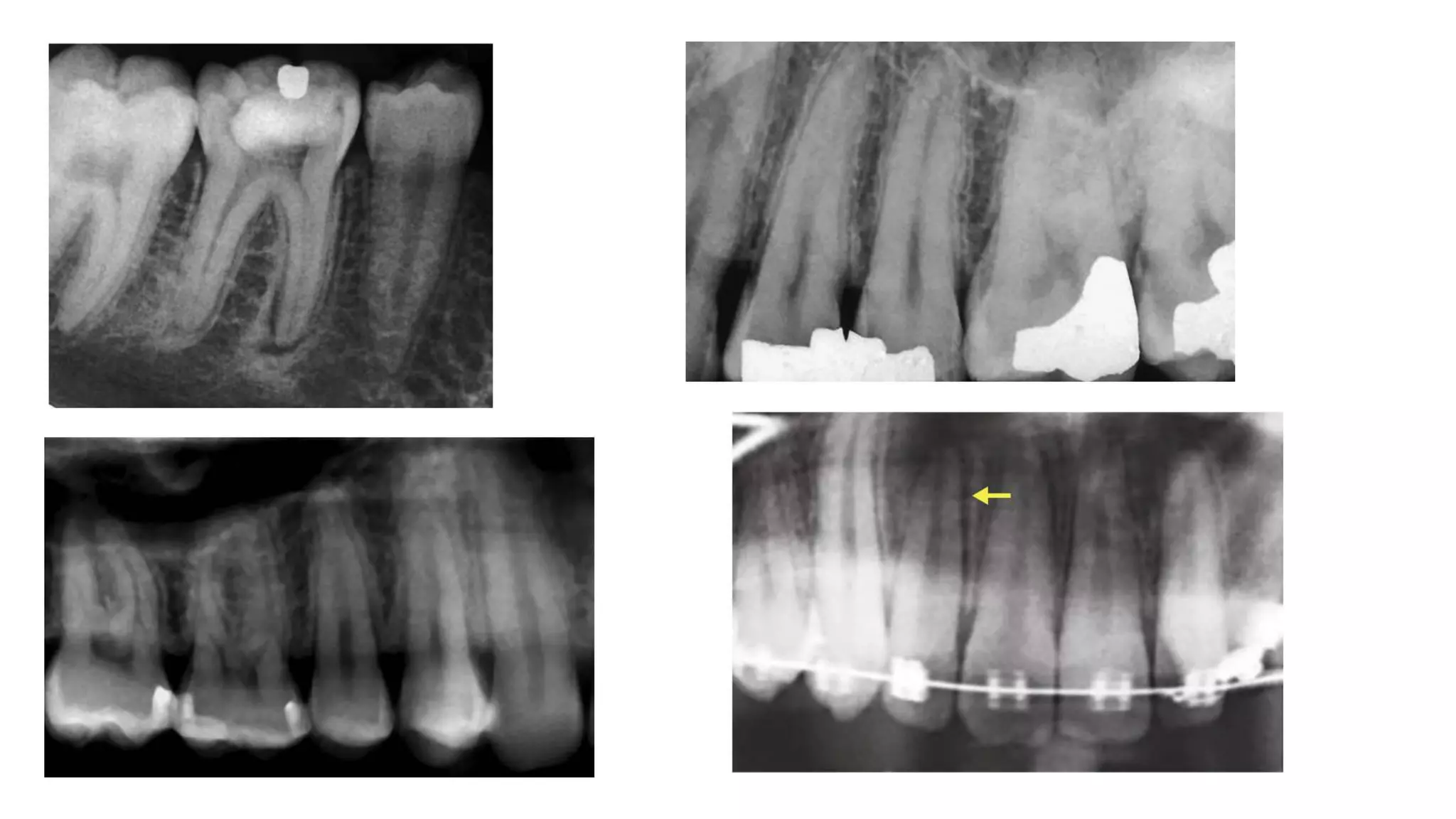 widening of PDL | PPTX