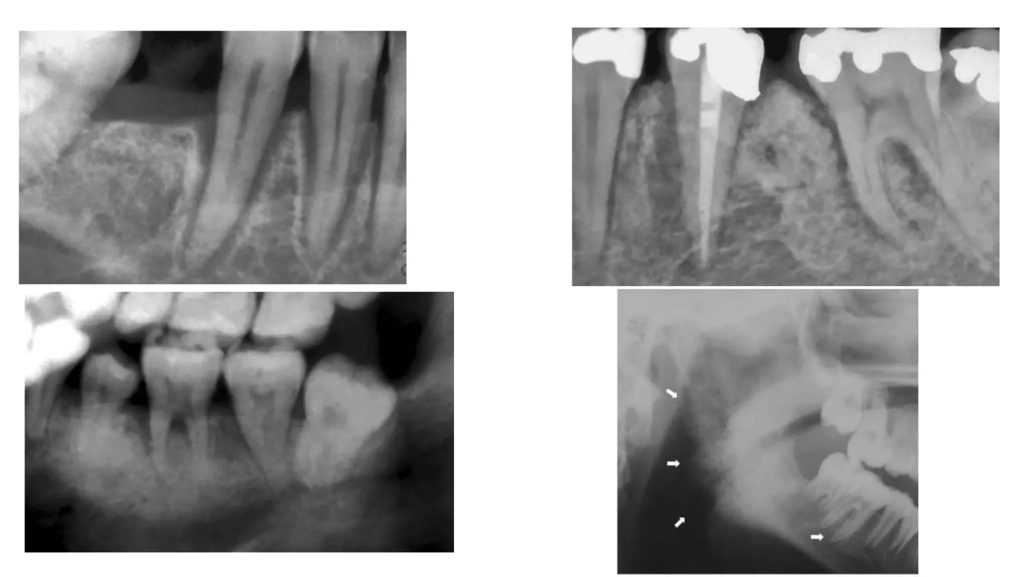 widening of PDL | PPTX