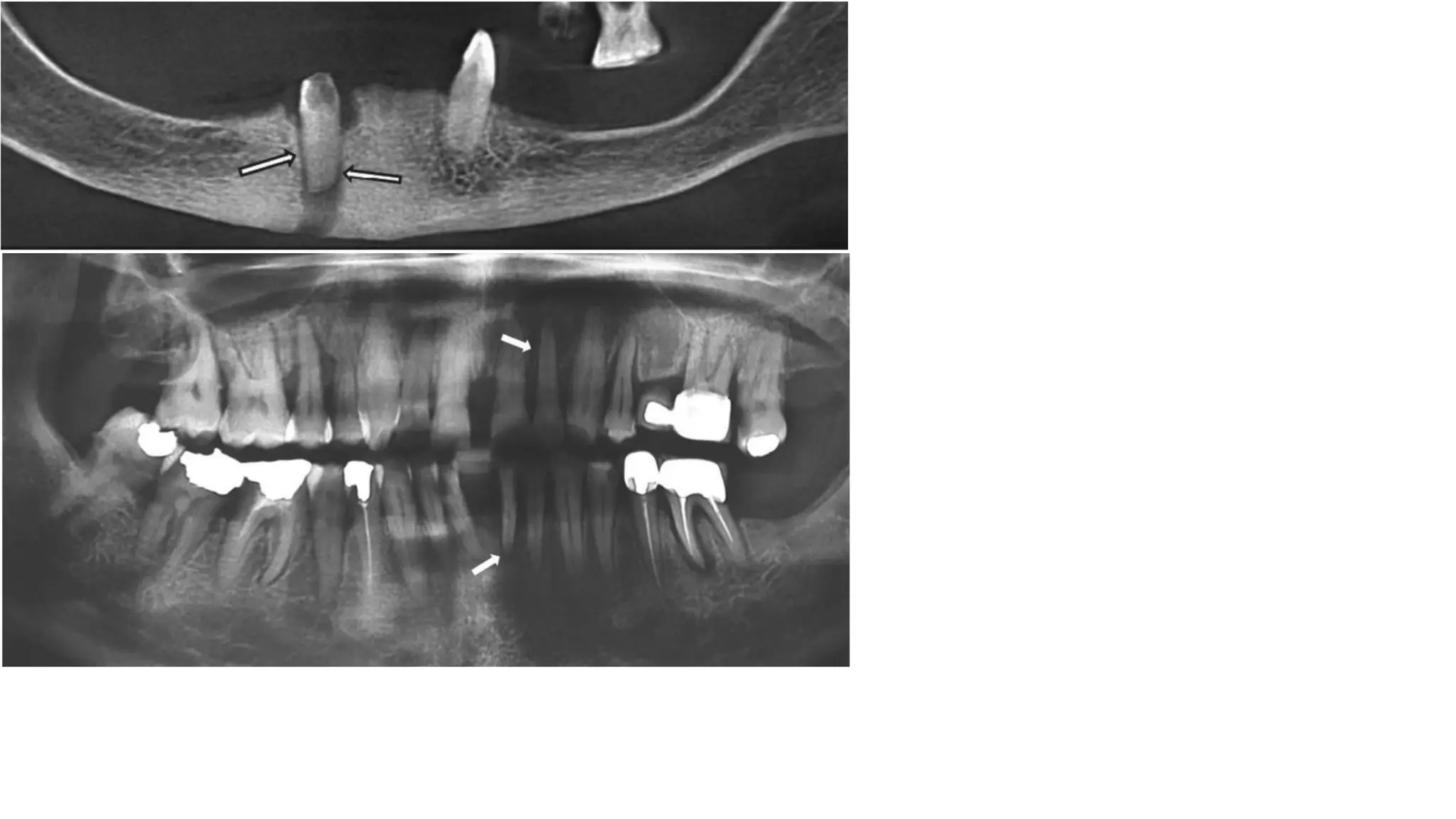 widening of PDL | PPTX