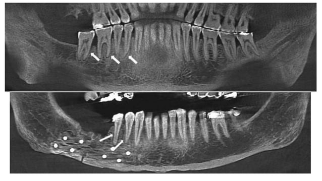 widening of PDL | PPTX