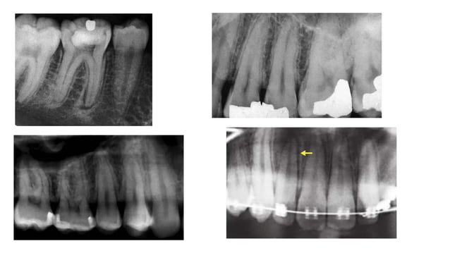 widening of PDL | PPTX