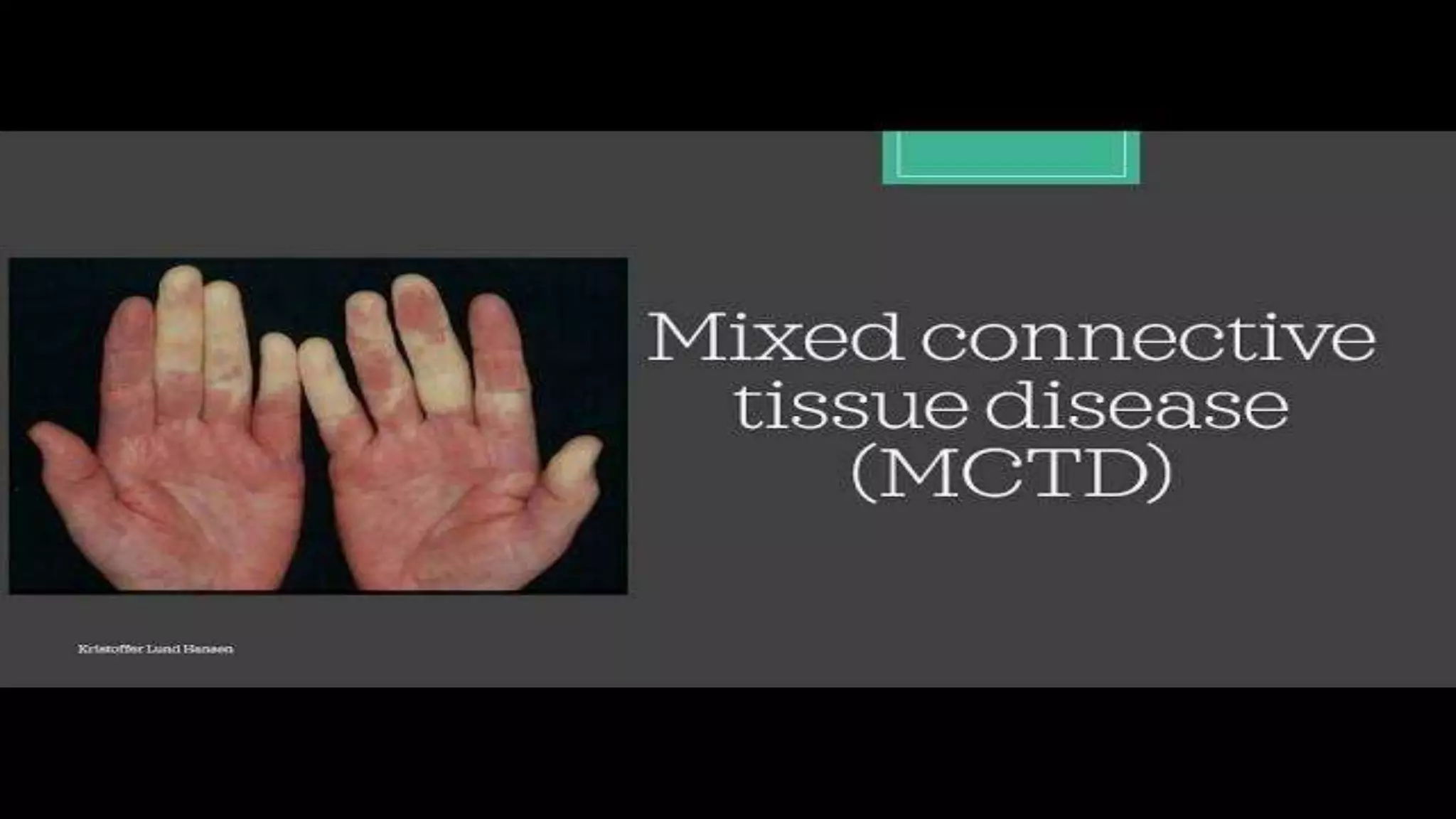 Mixed connective tissue disorder (case) | PPT