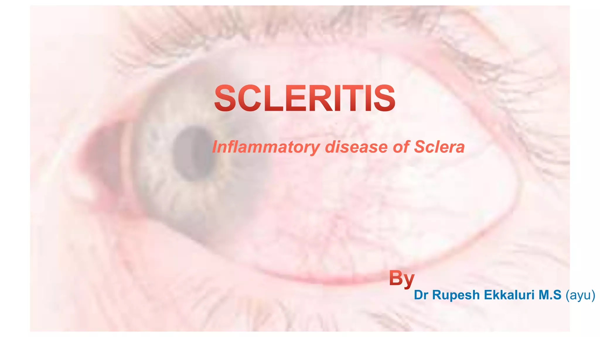 Scleritis.pptx | Eye and Vision Conditions | Diseases and Conditions