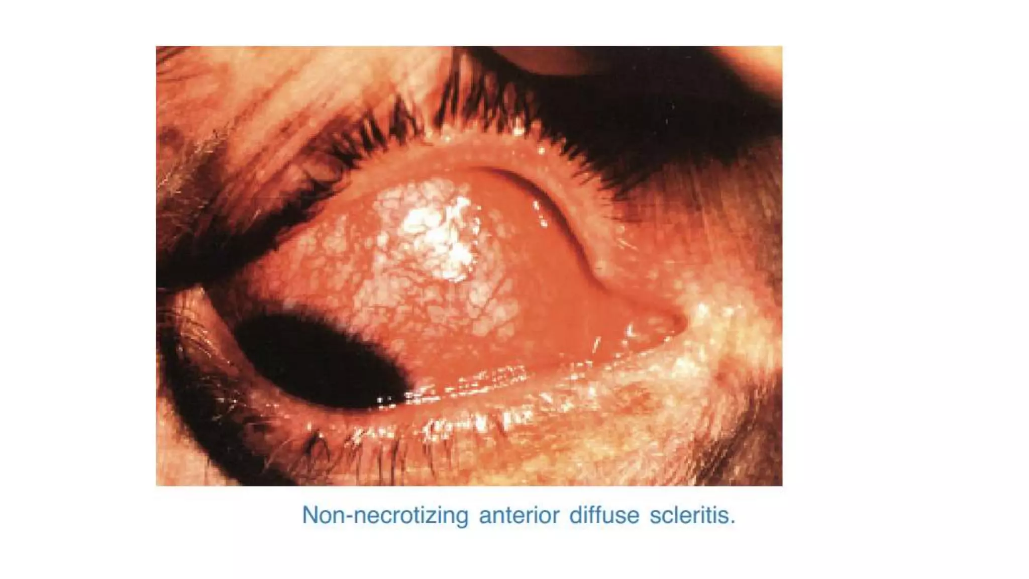 Scleritis.pptx | Eye and Vision Conditions | Diseases and Conditions