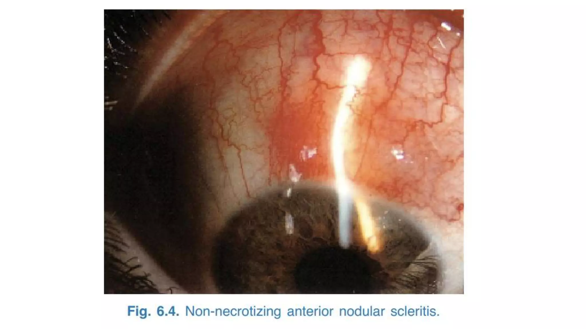 Scleritis.pptx | Eye and Vision Conditions | Diseases and Conditions