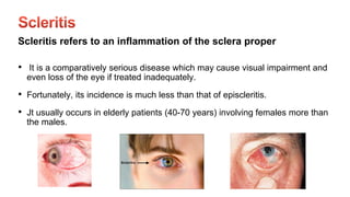 Scleritis.pptx | Eye and Vision Conditions | Diseases and Conditions