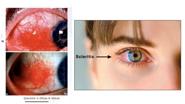 Scleritis.pptx | Eye and Vision Conditions | Diseases and Conditions