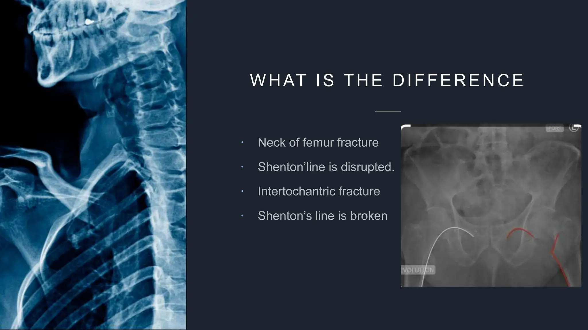 Fractures of neck of femur with mechanism | PPT