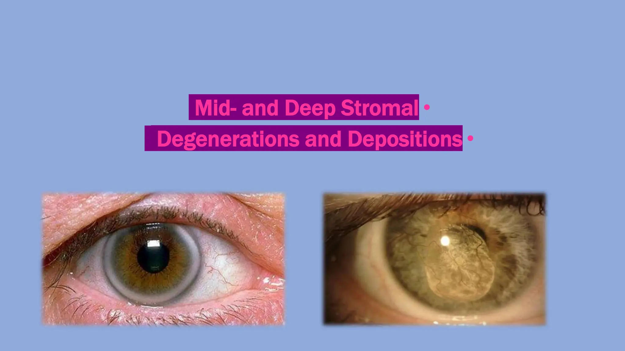Corneal degeneration and corneal deposition | PPT