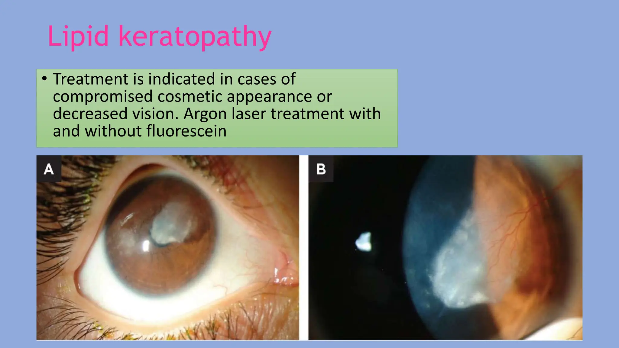 Corneal degeneration and corneal deposition | PPT