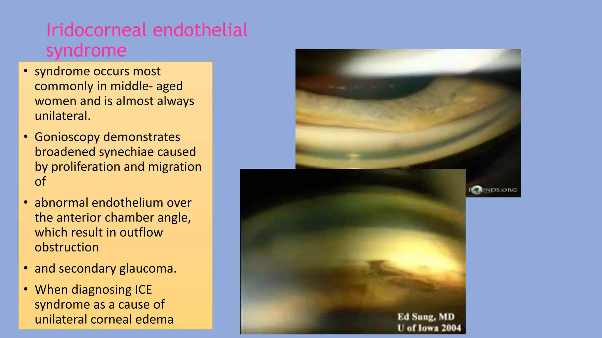 Corneal degeneration and corneal deposition | PPT