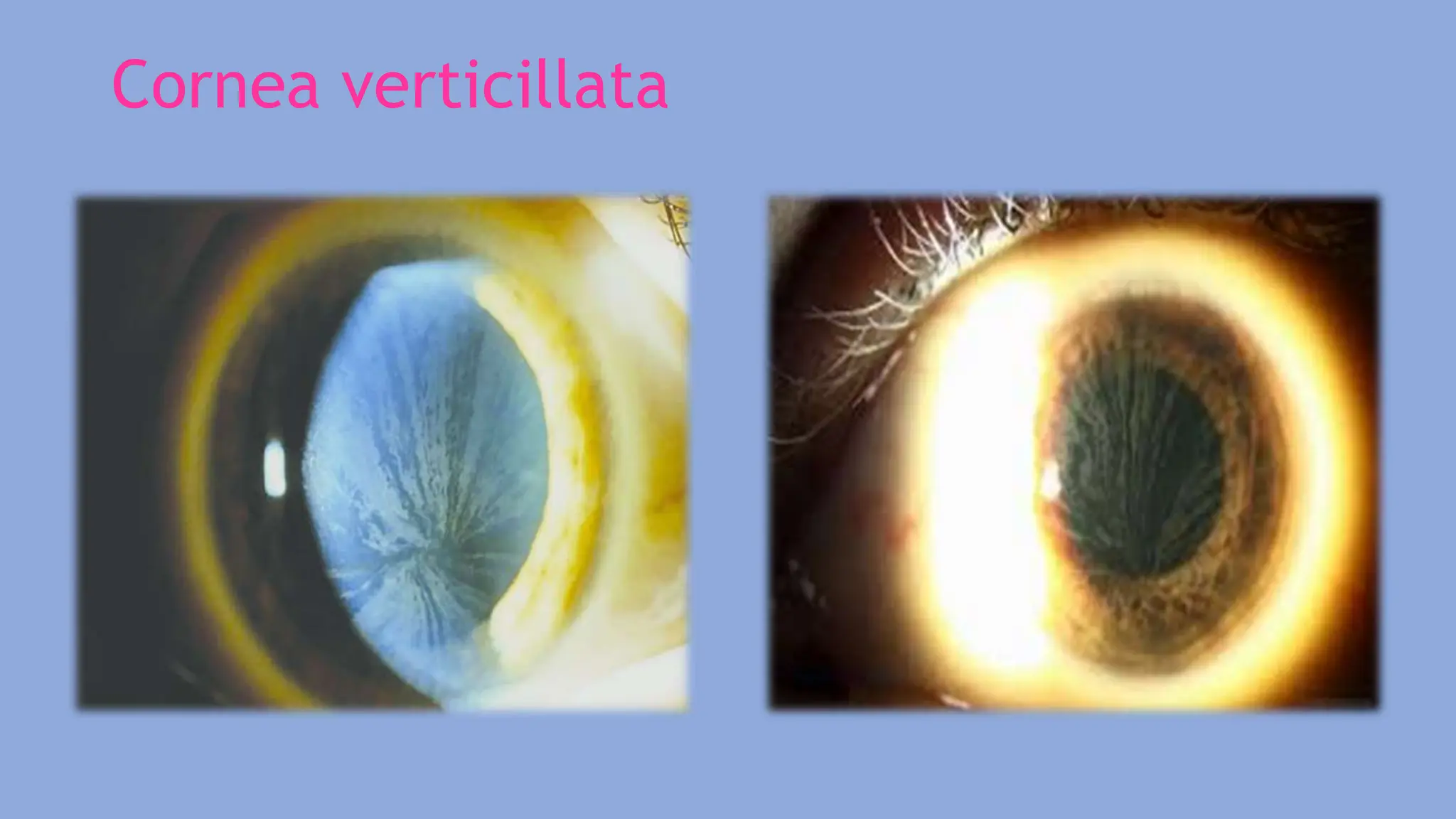 Corneal degeneration and corneal deposition | PPT