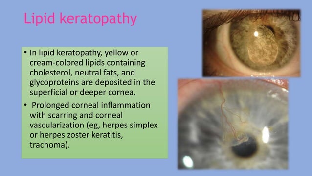 Corneal degeneration and corneal deposition | PPT